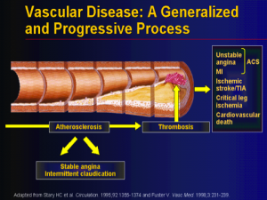Coronary Heart Disease - Central Sydney Cardiology